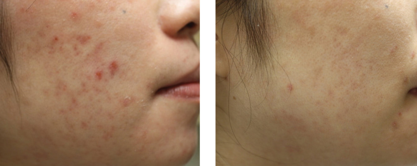 TheraClearX Acne Treatment | Effective Acne Vulgaris Therapy with No ...